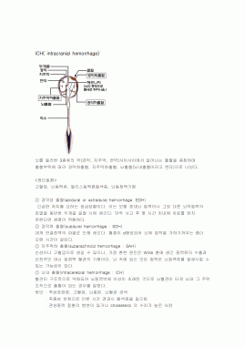 [자연과학] 두개내 출혈-1페이지