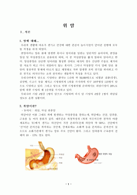 [논문] 위암(stomach cancer)-1페이지