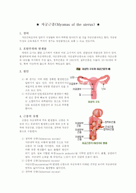 자궁근종 myoma uterine myoma 부인과-1페이지