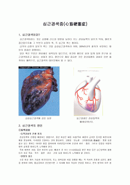 심혈관계질환 심근경색증 -1페이지