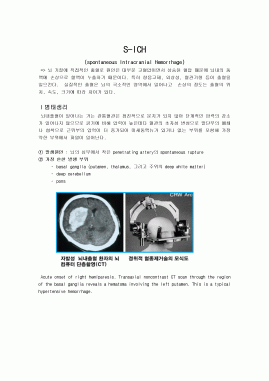 S-ICH (spontaneous Intracranial Hemorrhage) 경막하 출혈-1페이지