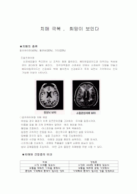 [생활의학]치매에 대해-1페이지