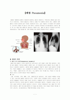 소아 폐렴-1페이지