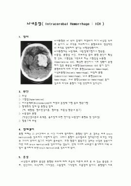 ICH (뇌내출혈)-1페이지