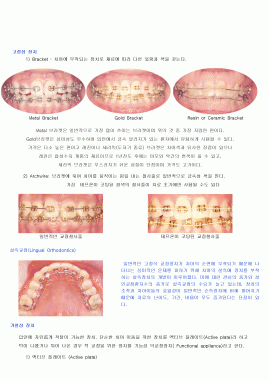 치의학-치아교정장치에 대한 레포트-1페이지