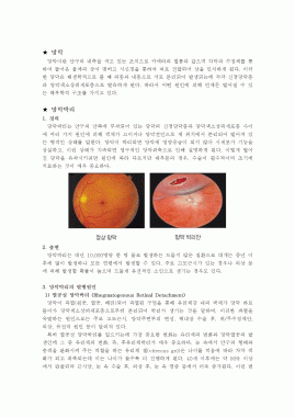 안질환 - 망막박리-1페이지