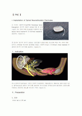 요실금수술, 천수 신경조절술, 천수신경자극술-1페이지