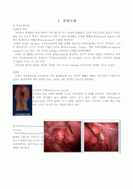 Leiomyoma of uterus, unspecified-1페이지