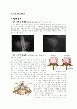 Spinal stenosis of lumbar spine-1페이지