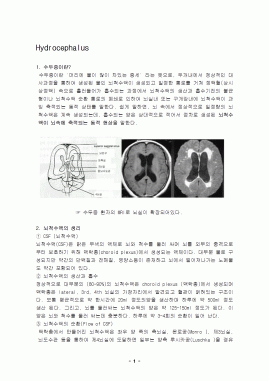 Hydrocephalus(수두증) 과 뇌실 복막 단락(V-P Shunt)-1페이지