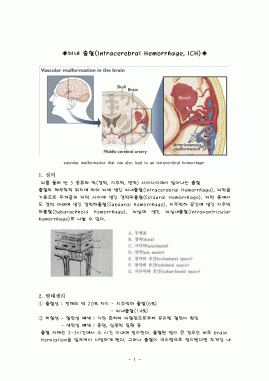 뇌내 출혈(Intracerebral Hemorrhage, ICH)-1페이지