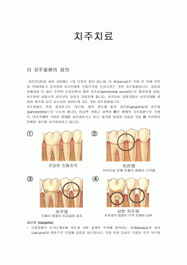 치주질환의 원인과 증상 및 치료방법-1페이지