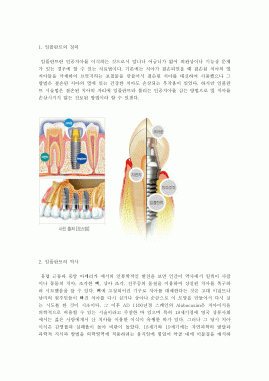 임플란트의 정의와 역사, 종류-1페이지