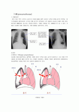 기흉 문헌고찰-1페이지