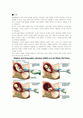 낙태에 관한 고찰-1페이지