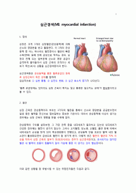 심근경색 MI-1페이지