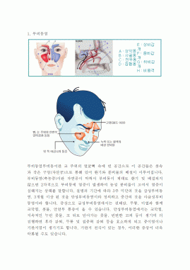 부비동염과 두개골절에 대한 자료-1페이지