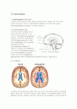 hydrocephalus 의 증상과 간호-1페이지