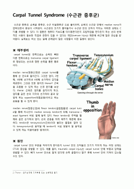 수근관 터널 증후군(carpal tunnel syndrome.CTS)-1페이지