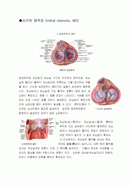 SICU질환명, 주요검사, 약, 의학용어 ( 승모판 협착증,폐색전증,담낭염) -1페이지