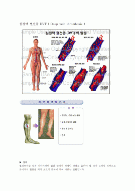 심정맥 혈전증 DVT-1페이지