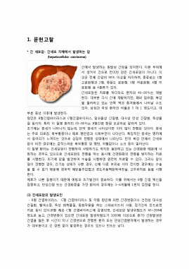 간세포암 문헌고찰(1)2-1페이지