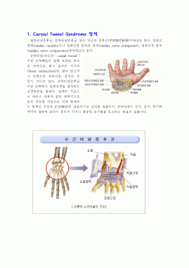 물리치료 팔목터널증후군-1페이지