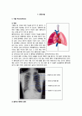 기흉컨퍼런스-1페이지