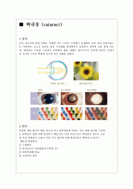 백내장과 녹내장-1페이지