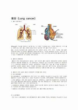 폐암 (Lung cancer)-1페이지