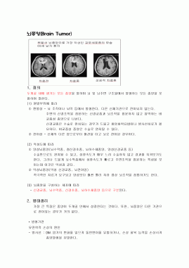 [신경외과] 뇌종양(Brain Tumor)-1페이지