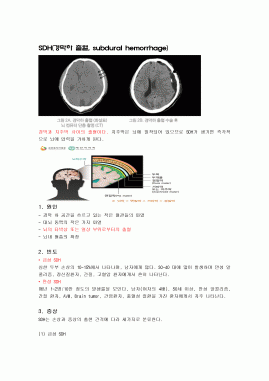 [신경외과] SDH(경막하 출혈, subdural hemorrhage)-1페이지