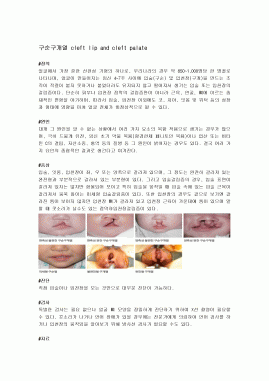 구순구개열 cleft lip and cleft palate 케이스-1페이지