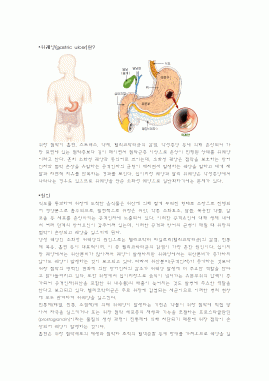 위궤양(gastric ulcer) 케이스-1페이지