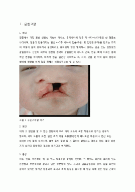 [아동 케이스] cleft palate 구개열 케이스-1페이지