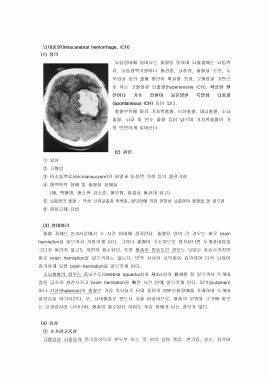 [의학] 뇌내출혈[intracerebral hemorrhage, ICH]-1페이지