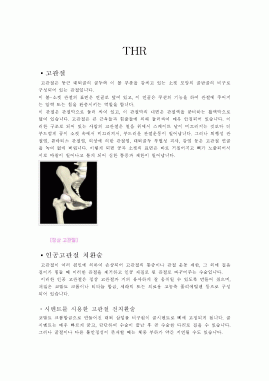 [의학] 고관절인공관절전치환술[Total Hip Replacement]에 관해-1페이지