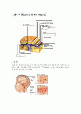 뇌수막염 (bacterial meningitis)-1페이지