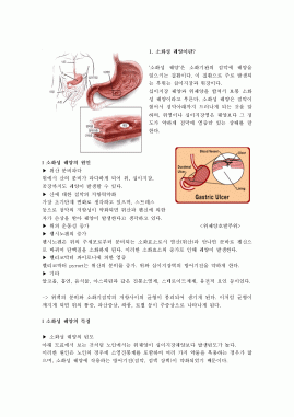 소화성 궤양에 대해-1페이지