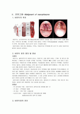 비인두암 케이스 스터디 Malignant neoplasm of nasopharynx case study-1페이지