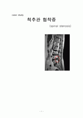 spinal stenosis-1페이지
