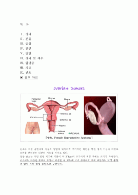 간호학 케이스 스터디 -난소종양(ovarian tumors)-1페이지