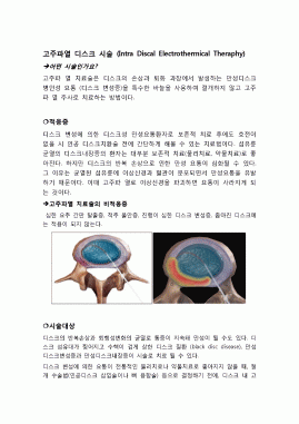 [의학] 고주파열 디스크 시술 (Intra Discal Electrothermical Theraphy)-1페이지