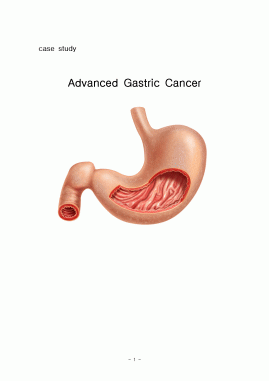 [간호학 case study] 간호실습, 위암, AGC : Advanced gastric cancer, 간호학-1페이지
