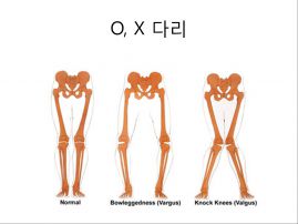 0 & X 다리의 이해 및 운동運動 방법-1페이지