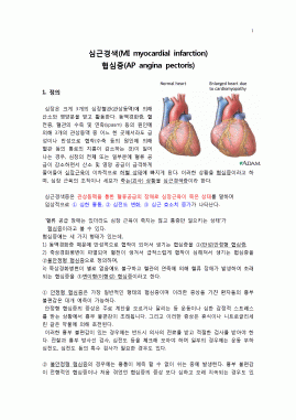 심근경색과 협심증-1페이지