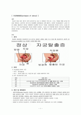 자궁탈출증(prolapse of uterus) case study / 여성간호학 실습 컨퍼런스-1페이지