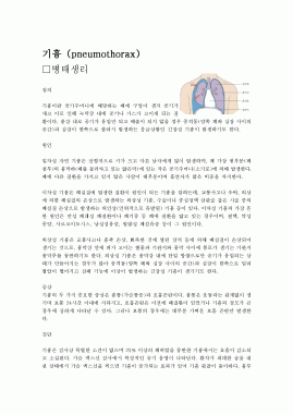 <성인간호학>기흉 병태와 간호진단-1페이지