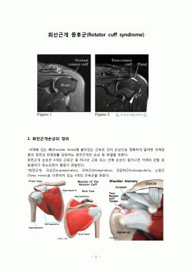 회선근개 증후군 Rotator cuff syndrome case-1페이지