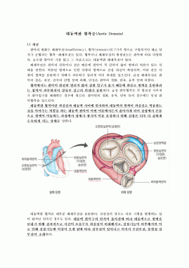 [성인간호] 대동맥판 협착증(Aorta stenosis) 병태생리-1페이지